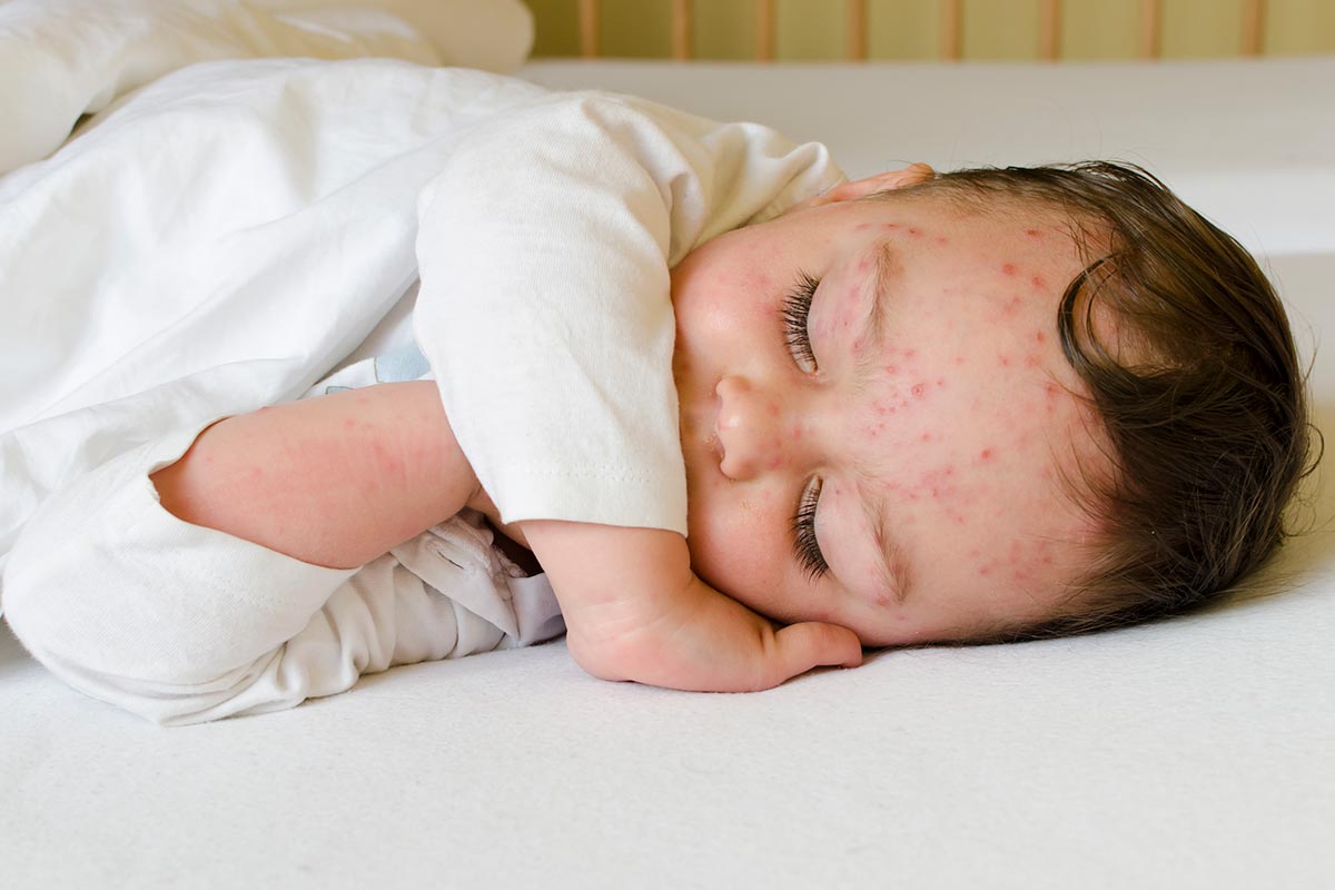 Vodene koze ali norice: Ponavadi jih prebolimo v otroštvu | Zdravje